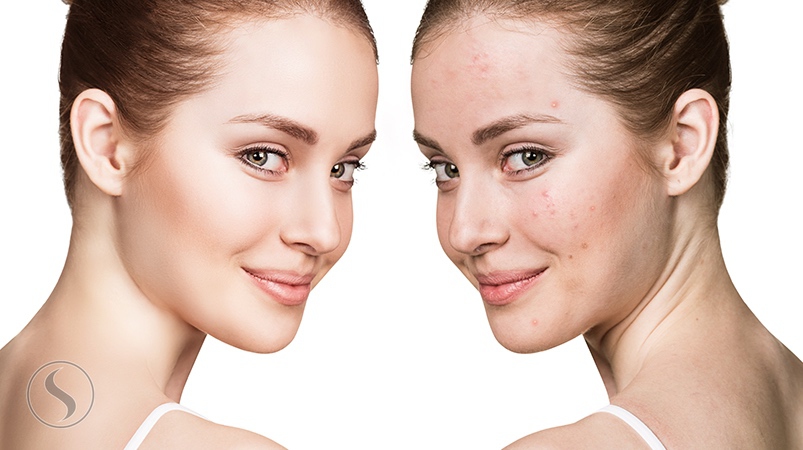 Tratament medicamentos pentru acnee - tratament acnee severă | SKINOVATE