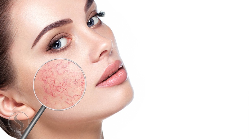 Tratament pentru acneea rozacee cu laser vascular | SKINOVATE